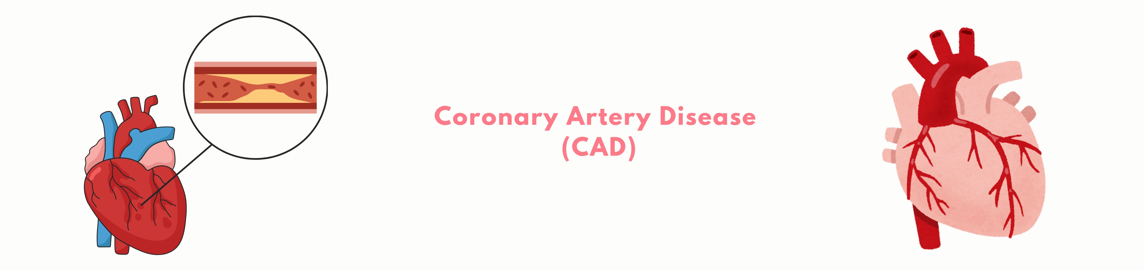 Suggest Doctors - Coronary Artery Disease (CAD) | Diseases and ...