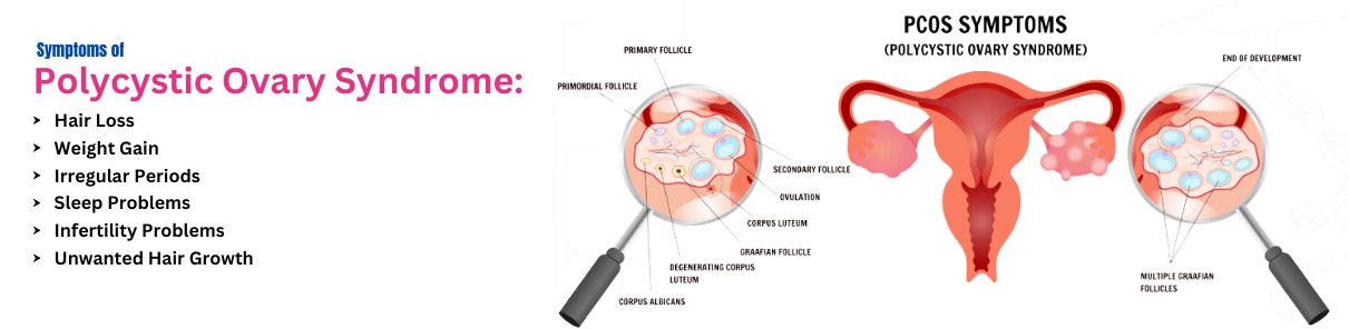 Polycystic Ovary Syndrome (PCOS) | Polycystic Ovary Syndrome (PCOS ...