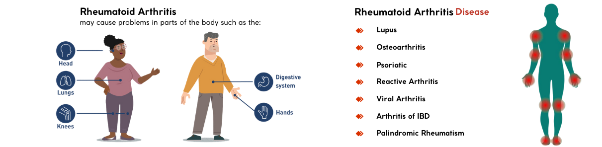 Rheumatoid Arthritis (RA) | Rheumatoid Arthritis (RA) | Diseases and ...